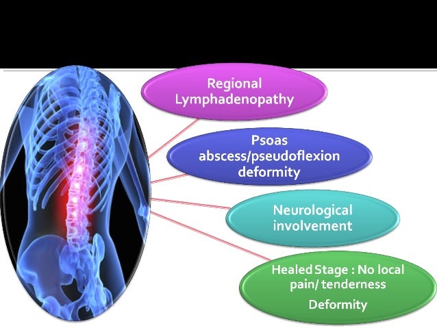 Tuberculosis Of Spine