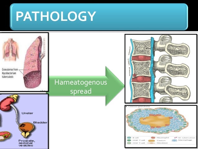 Tuberculosis of spine
