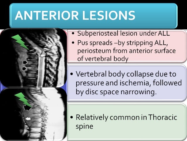 Tuberculosis Of Spine