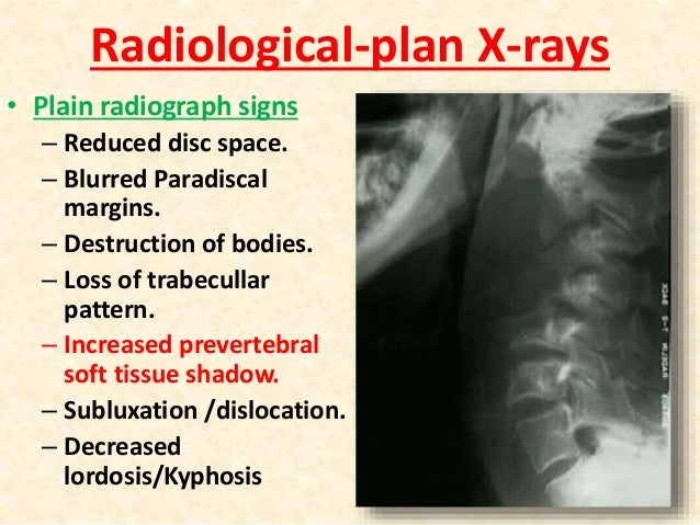 Tuberculosis Of Spine
