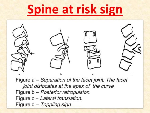 Tuberculosis of spine