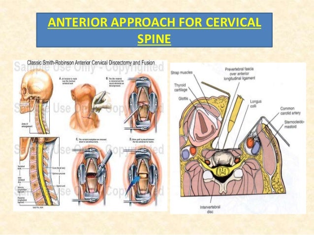 Tuberculosis of spine
