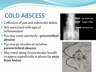 TUBERCULOSIS OF SPINE.pptx
