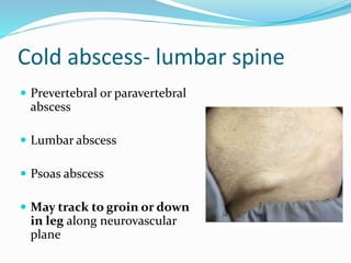 TUBERCULOSIS OF SPINE.pptx