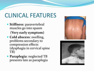 TUBERCULOSIS OF SPINE.pptx