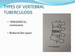 TUBERCULOSIS OF SPINE.pptx