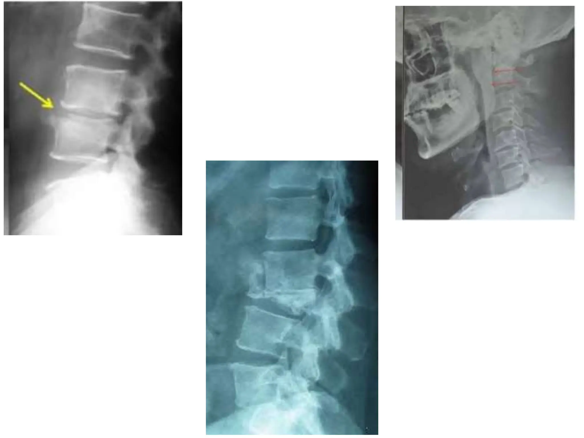 TUBERCULOSIS OF SPINE by Ravi pg student | PPT