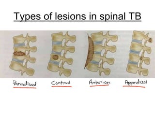 TUBERCULOSIS OF SPINE by Ravi pg student | PPTX