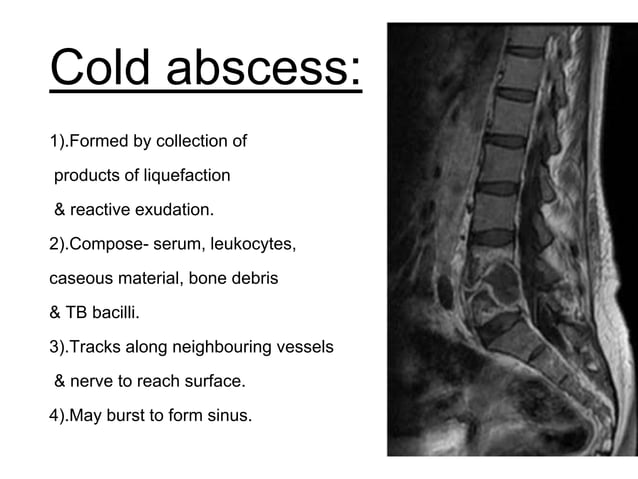 TUBERCULOSIS OF SPINE by Ravi pg student | PPT