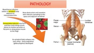 Tuberculosis of spine mad | PPTX