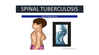 Tuberculosis of spine mad | PPT