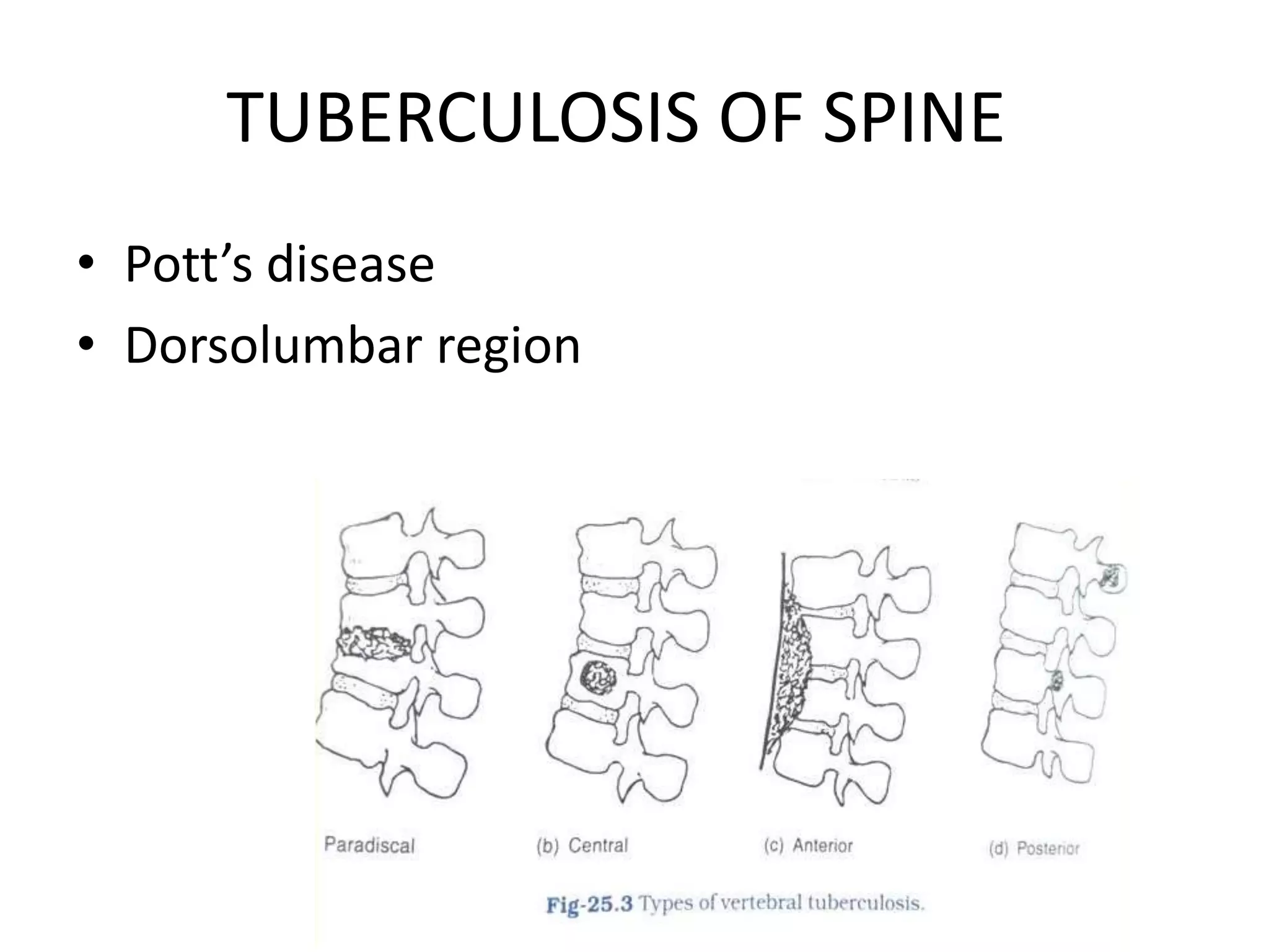 Tuberculosis of spine and hip joint | PPTX