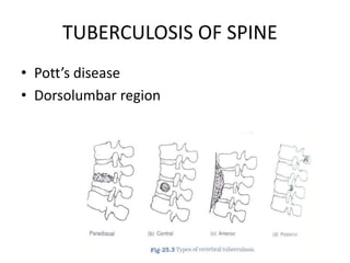 Tuberculosis of spine and hip joint | PPTX