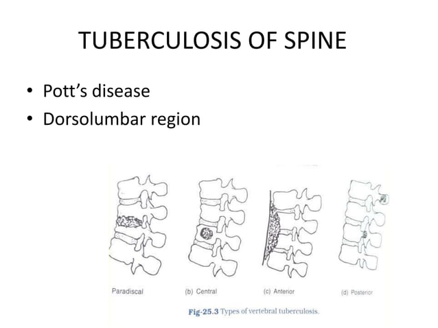 Tuberculosis of spine and hip joint | PPT