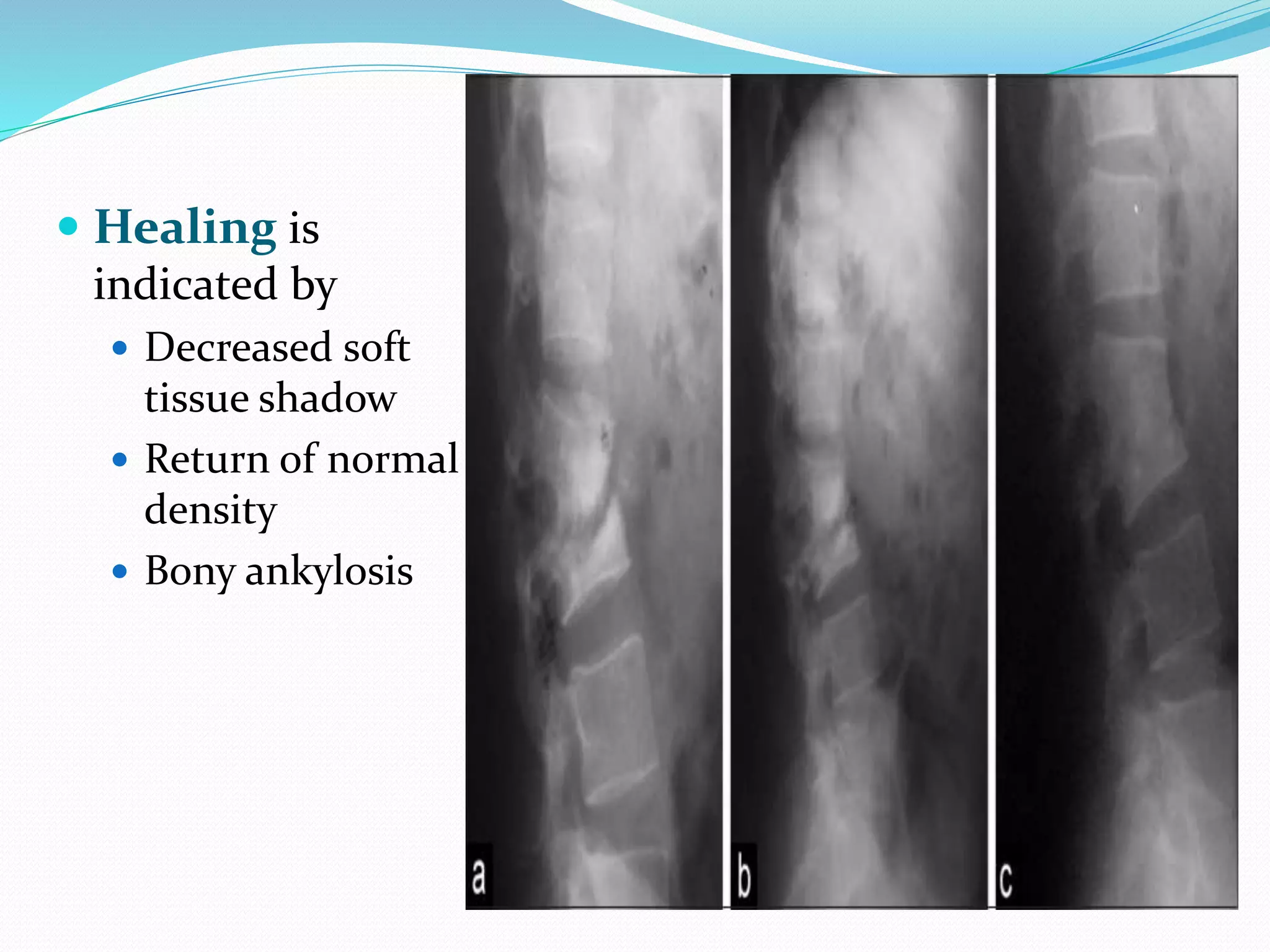 Tuberculosis of spine (pott’s spine) | PPTX