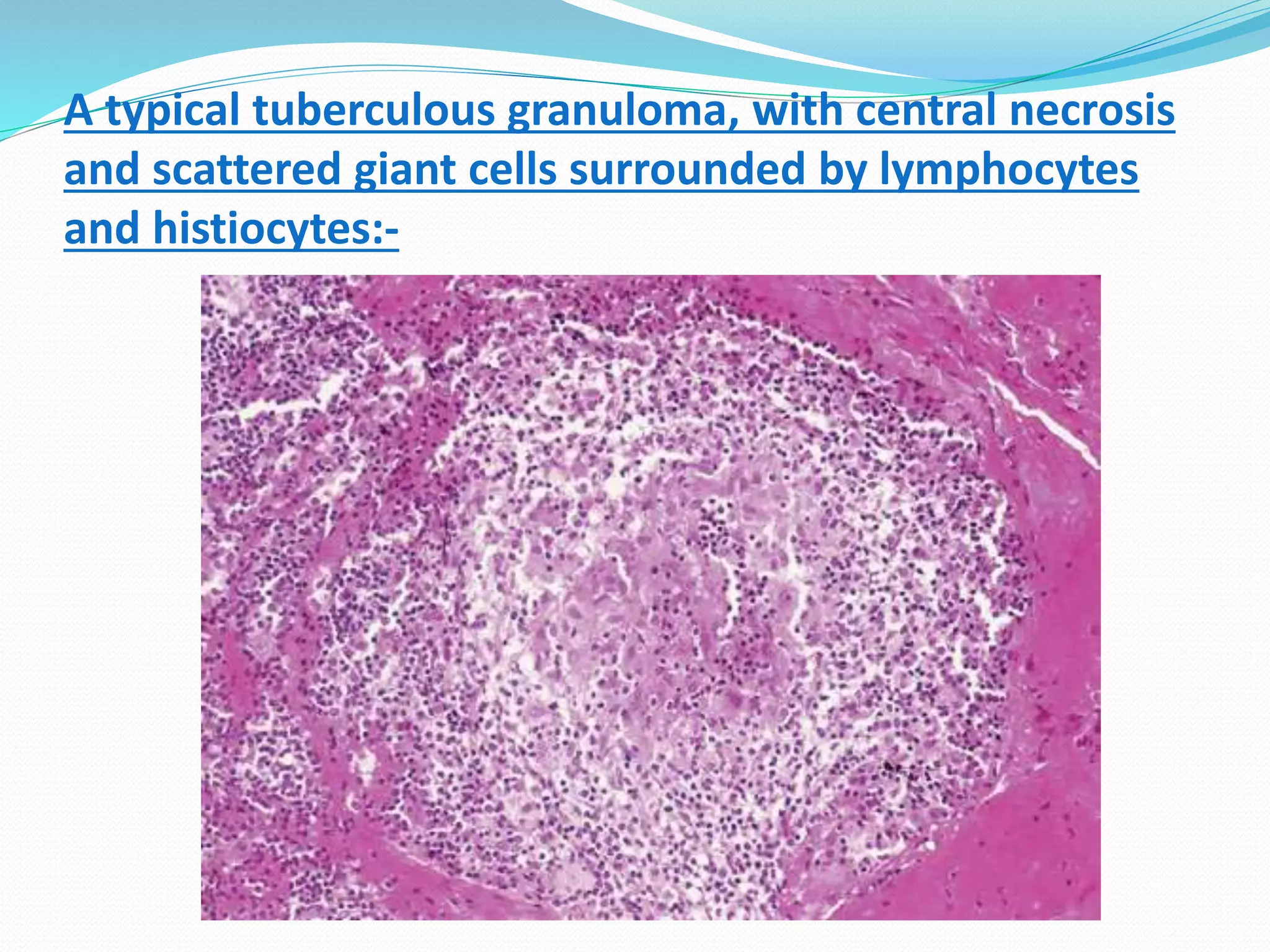 Tuberculosis of spine (pott’s spine) | PPTX | Physical Therapy | Wellness