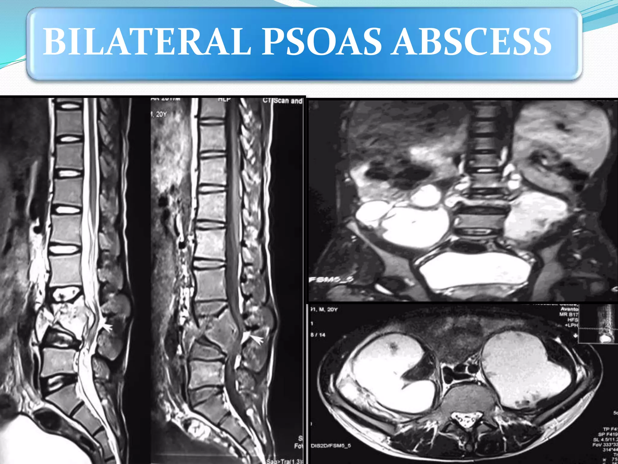 Tuberculosis of spine (pott’s spine) | PPTX