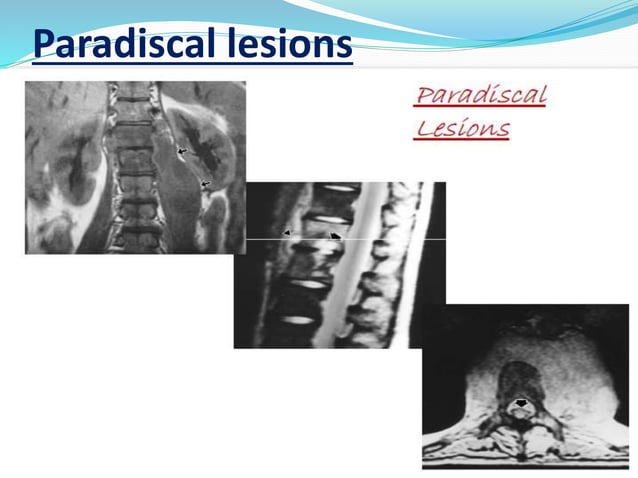 Tuberculosis of spine (pott’s spine) | PPTX | Physical Therapy | Wellness