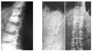 TUBERCULOSIS OF THE SPINE AND MANAGEMENT | PPTX