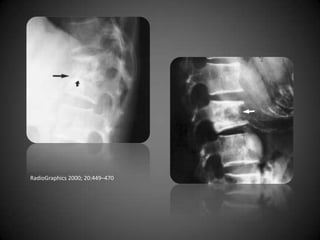Tuberculosis osea y articular | PPTX