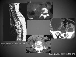 Tuberculosis osea y articular | PPTX