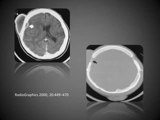 Tuberculosis osea y articular | PPTX