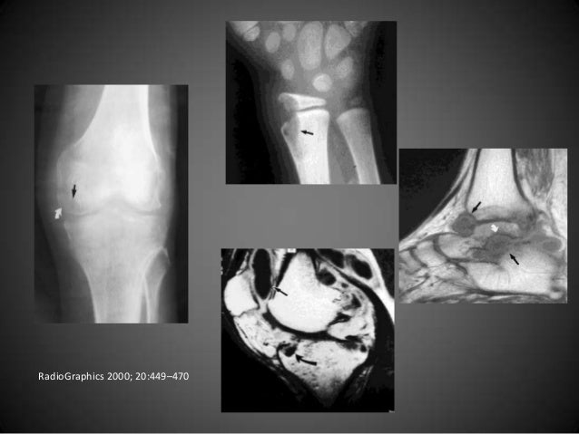 Tuberculosis osea y articular
