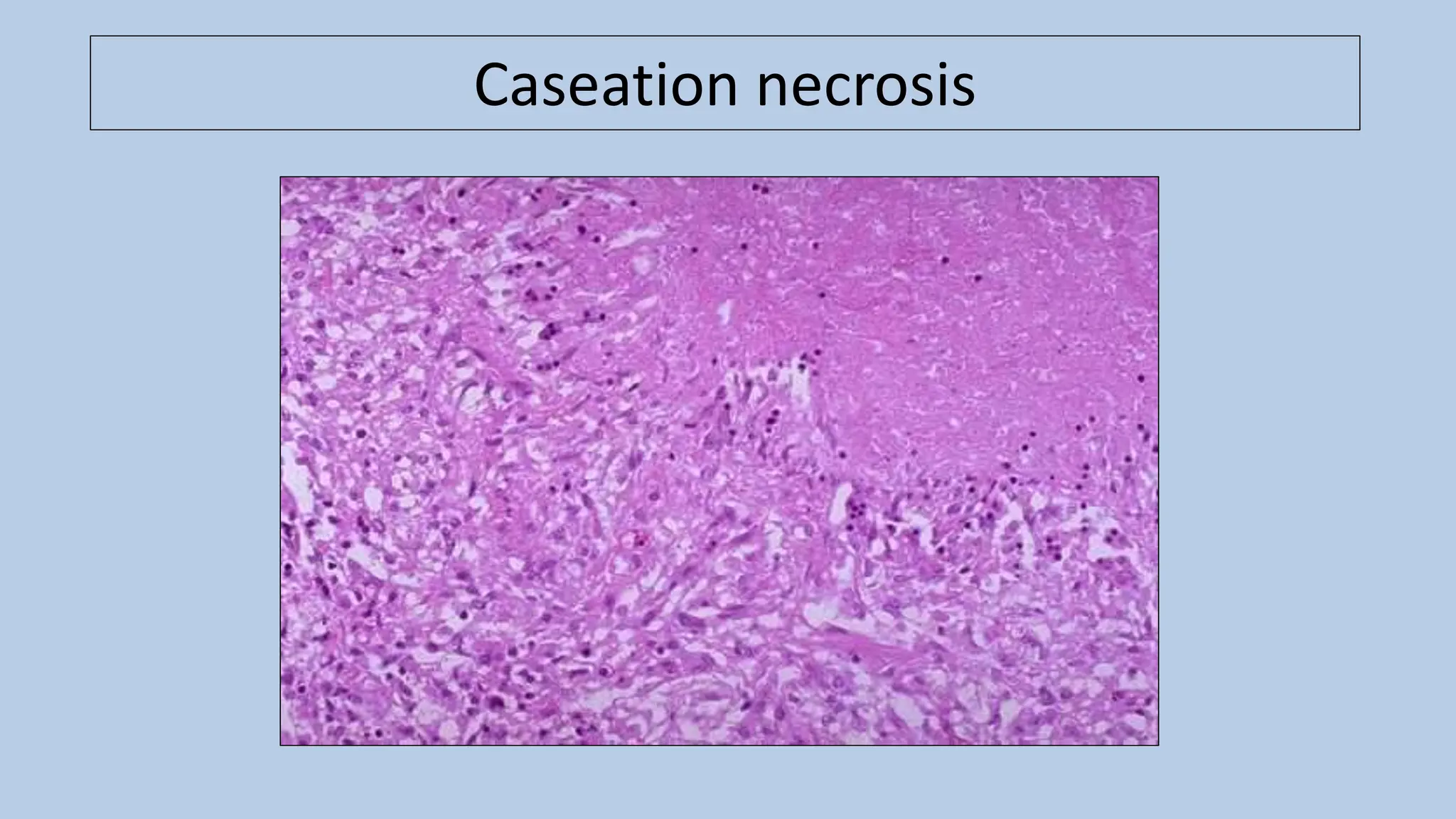 Tuberculosis pathophysiology and diagnosis | Jindal Chest Clinic | PPTX