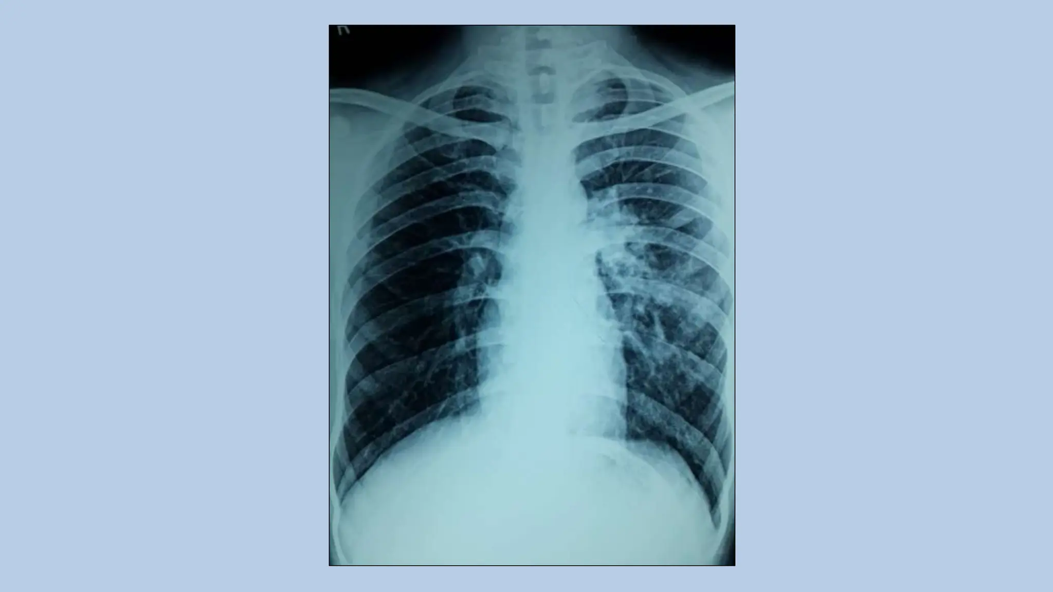 Tuberculosis pathophysiology and diagnosis | Jindal Chest Clinic | PPT