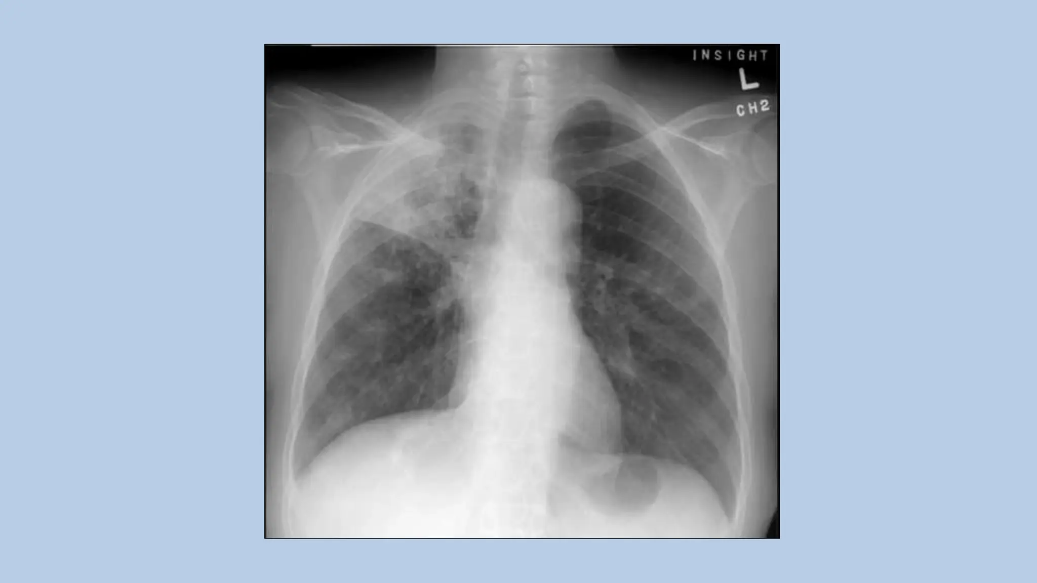 Tuberculosis pathophysiology and diagnosis | Jindal Chest Clinic | PPT