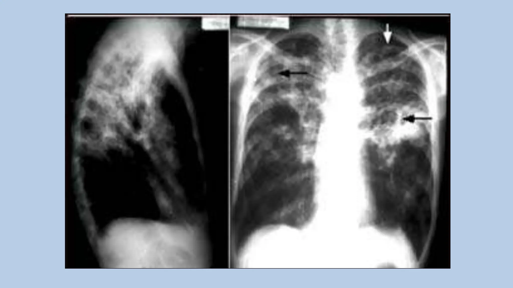 Tuberculosis pathophysiology and diagnosis | Jindal Chest Clinic | PPT