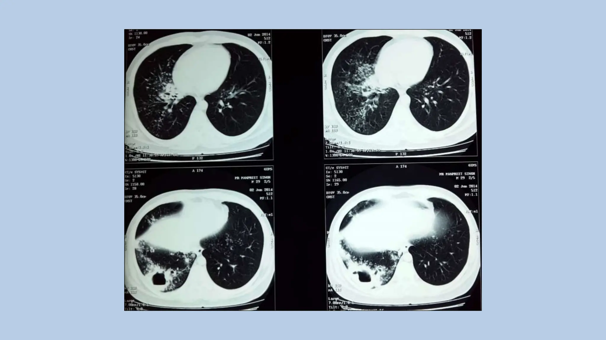 Tuberculosis pathophysiology and diagnosis | Jindal Chest Clinic | PPT