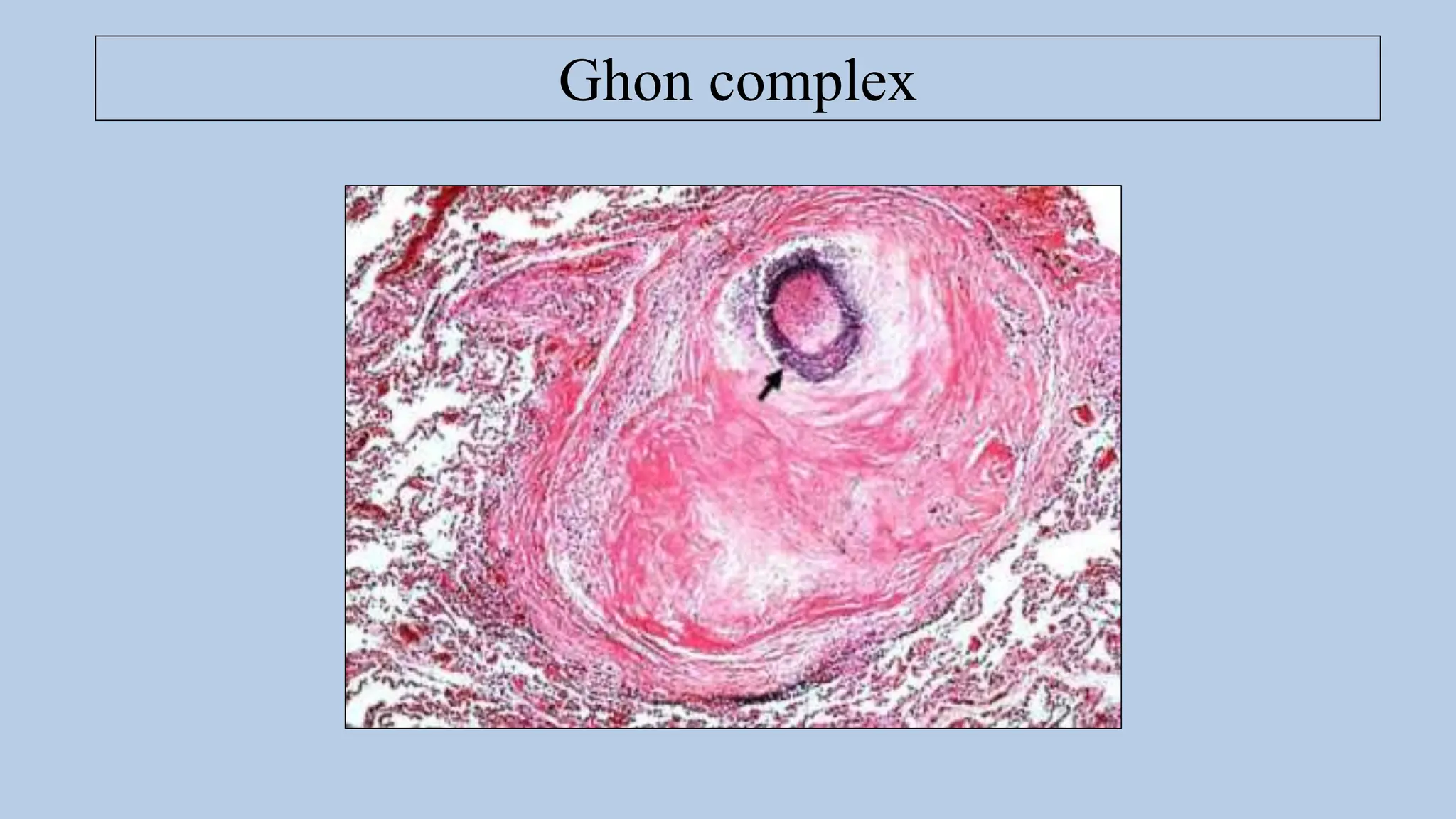Tuberculosis pathophysiology and diagnosis | Jindal Chest Clinic | PPTX