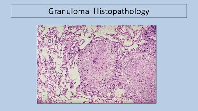 Tuberculosis pathophysiology and diagnosis | Jindal Chest Clinic | PPT