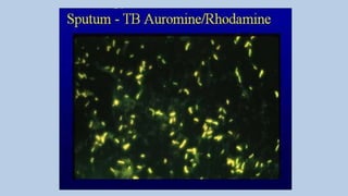 Tuberculosis pathophysiology and diagnosis | Jindal Chest Clinic | PPTX
