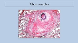 Tuberculosis pathophysiology and diagnosis | Jindal Chest Clinic | PPTX