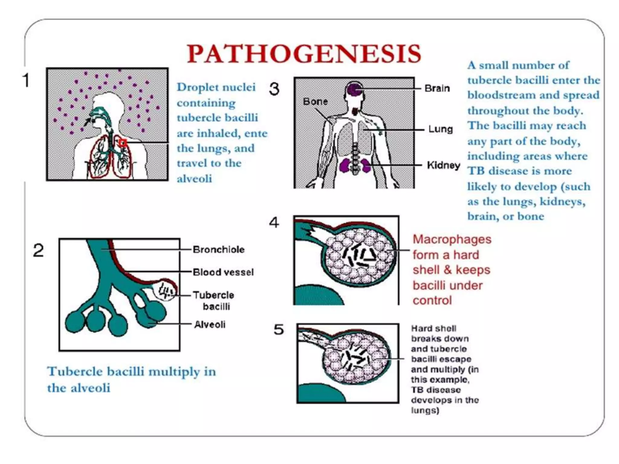 Tuberculosis ppt | PPTX