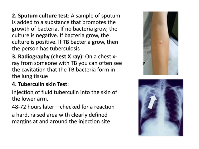 Tuberculosis ppt | PPT