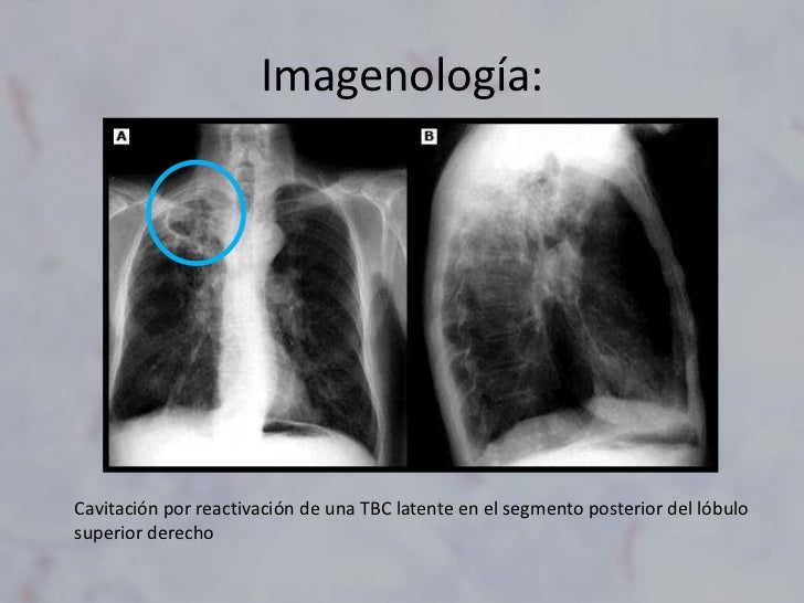 Tuberculosis pulmonar