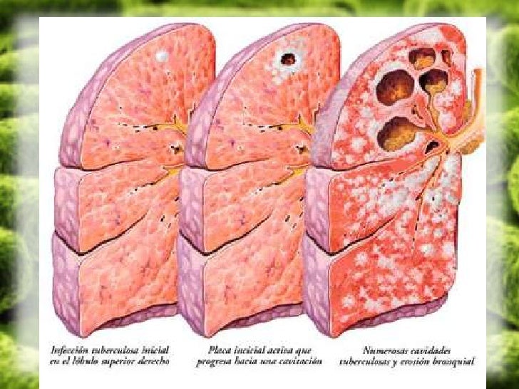 Tuberculosis pulmonar