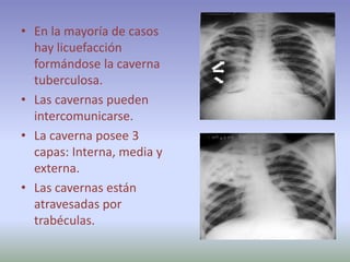 Tuberculosis pulmonar | PPTX