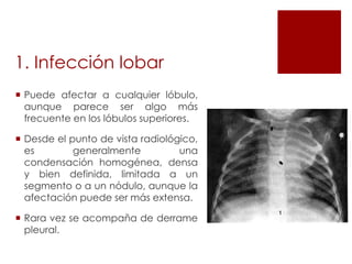 Tuberculosis pulmonar | PPTX