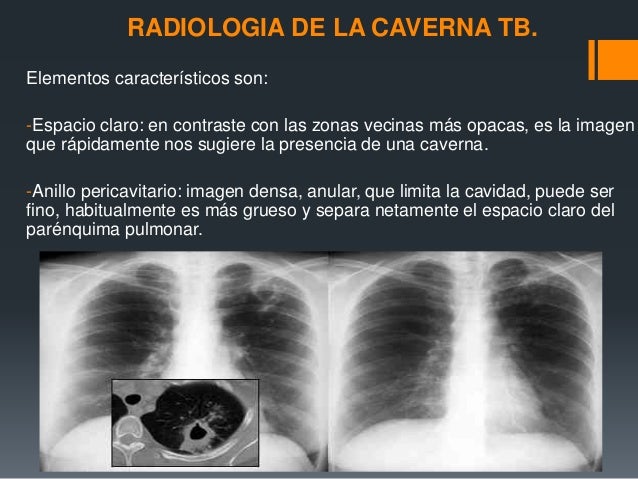 Actualizacion de la Tuberculosis pulmonar diagnóstico Imagenológico