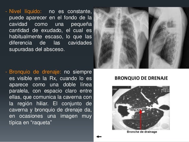 Actualizacion de la Tuberculosis pulmonar diagnóstico Imagenológico