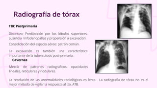 Tuberculosis pulmonar | PDF