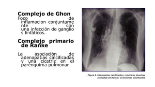 TUBERCULOSIS PULMONAR (1).pptx