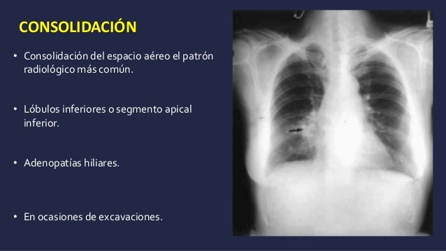 Tuberculosis pulmonar en la radiografía de tórax