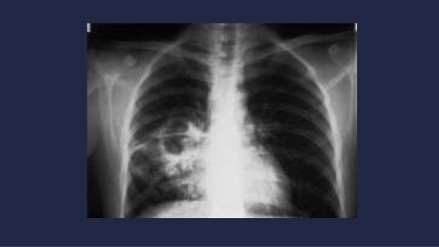 Tuberculosis pulmonar en la radiografía de tórax