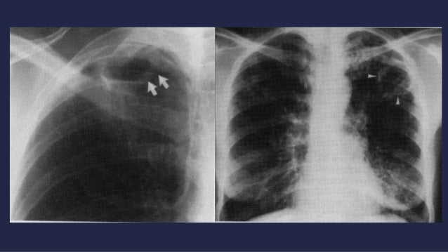 Tuberculosis: Diagnostico