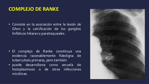 Tuberculosis pulmonar en la radiografía de tórax